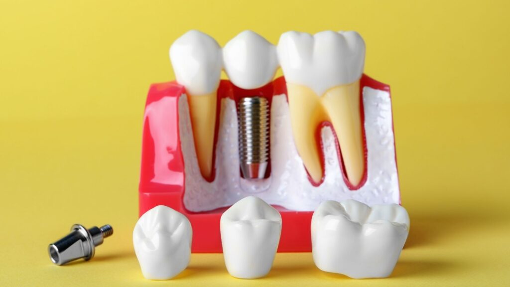 Staged Dental Implants: A Smarter Path to Full-Arch Tooth Replacement ...
